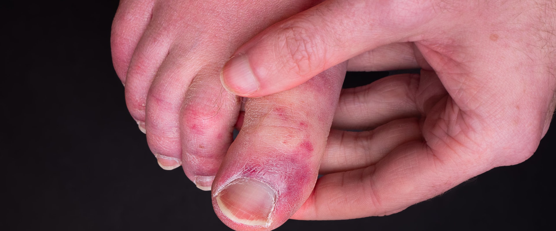 Red Spots on Your Foot? Here's Why Your Foot Has Red Spots and How to ...